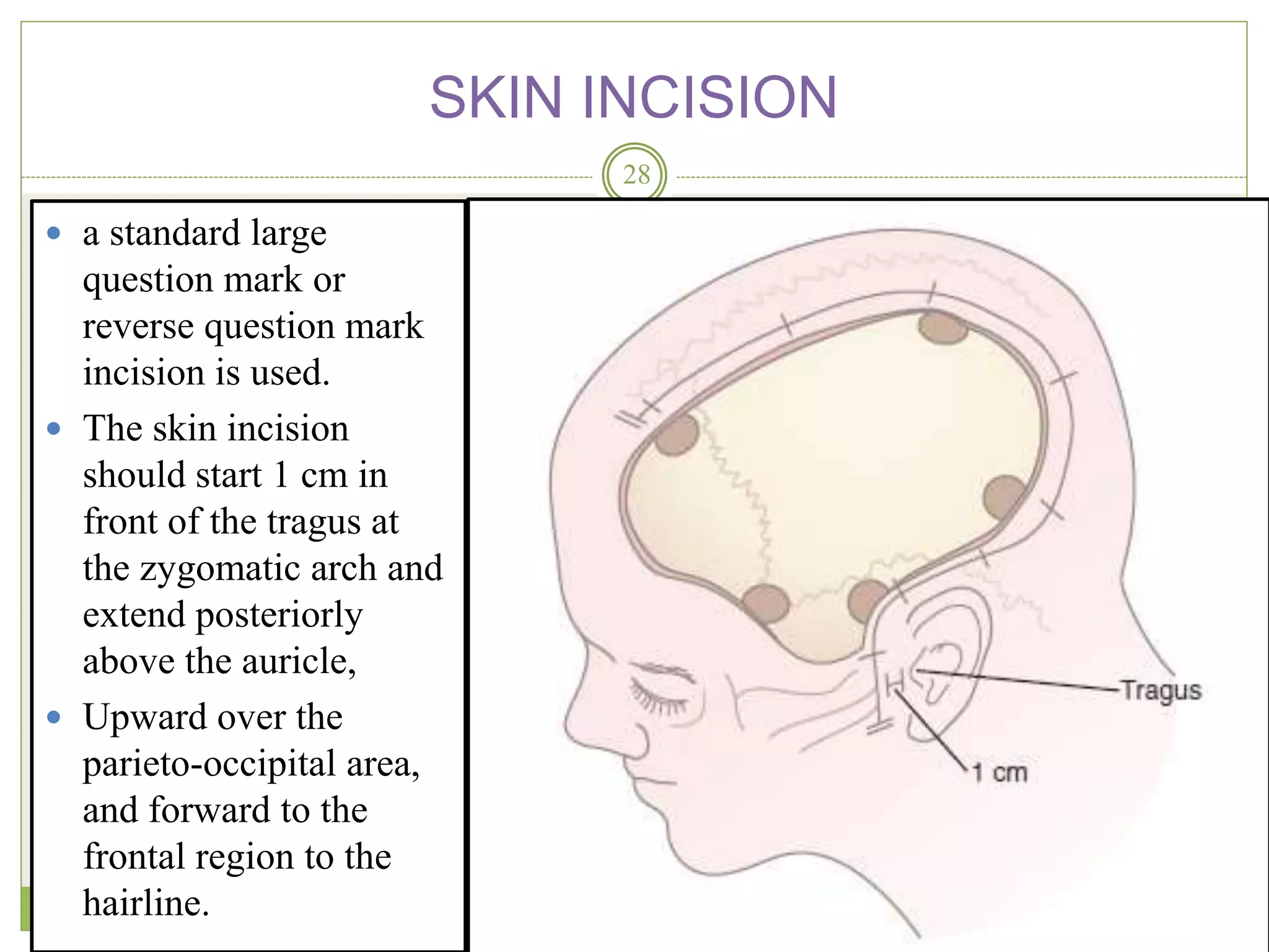 Decompressive craniectomy | PPTX