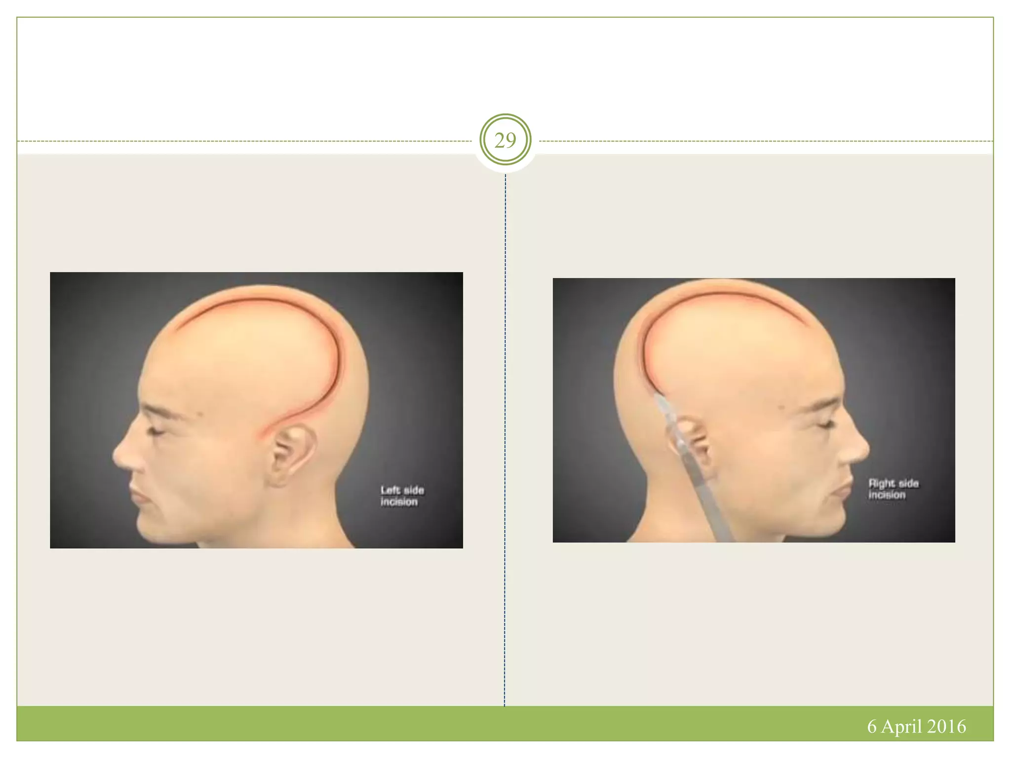 Decompressive craniectomy | PPTX