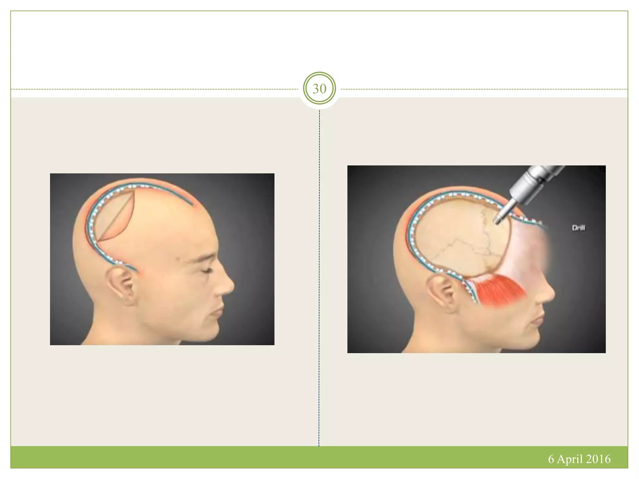 Decompressive craniectomy | PPTX