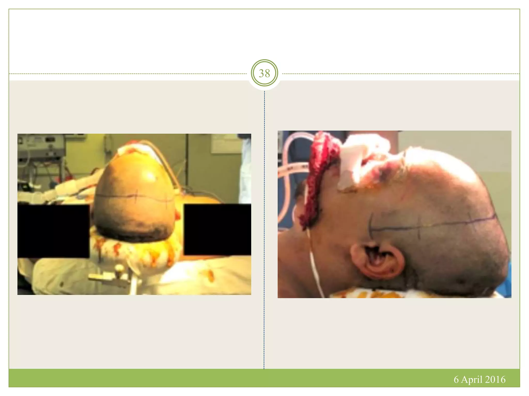 Decompressive craniectomy | PPTX | Death, Injury, or Military Conflict ...