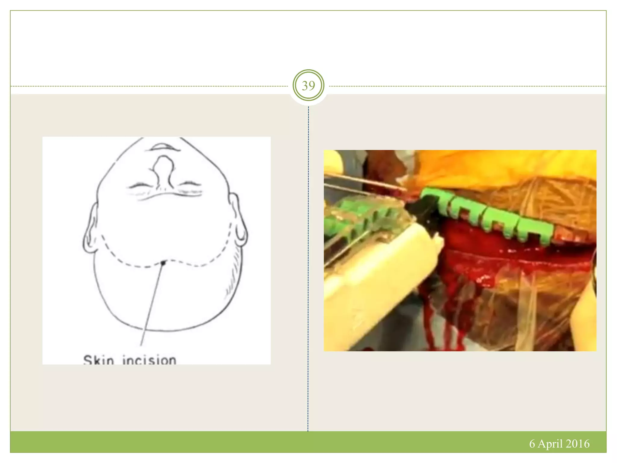 Decompressive craniectomy | PPTX