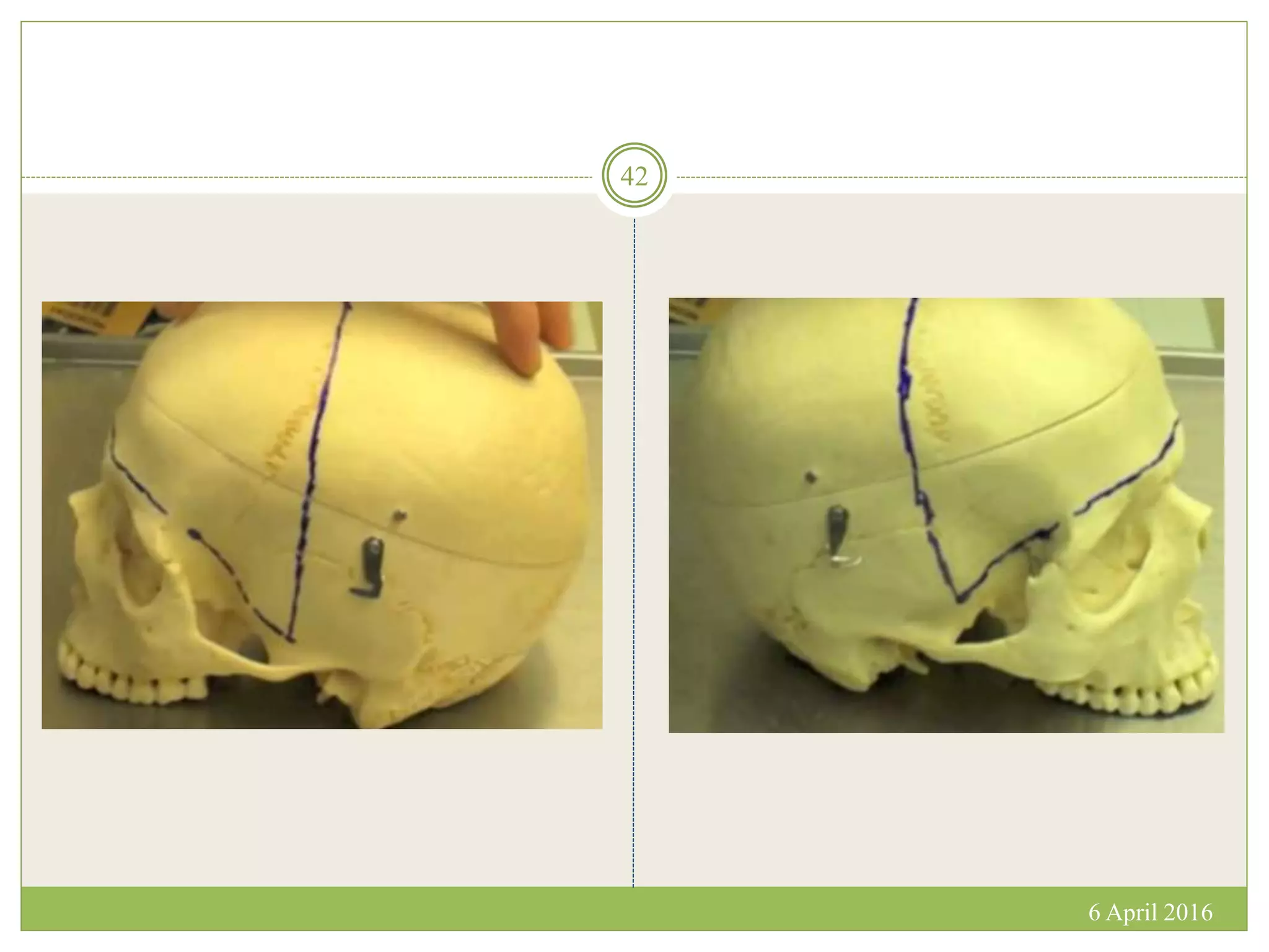 Decompressive craniectomy | PPTX
