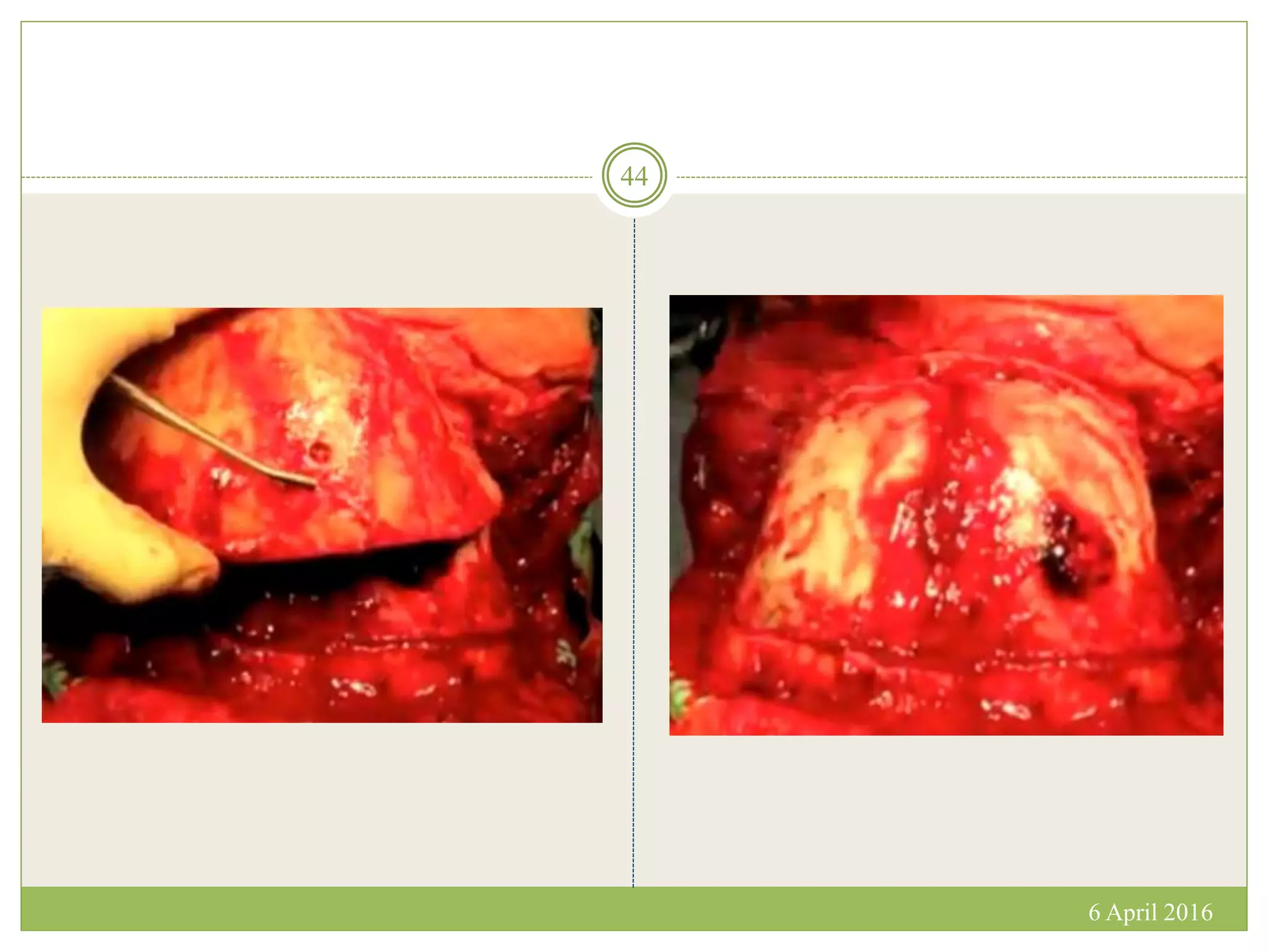 Decompressive craniectomy | PPTX