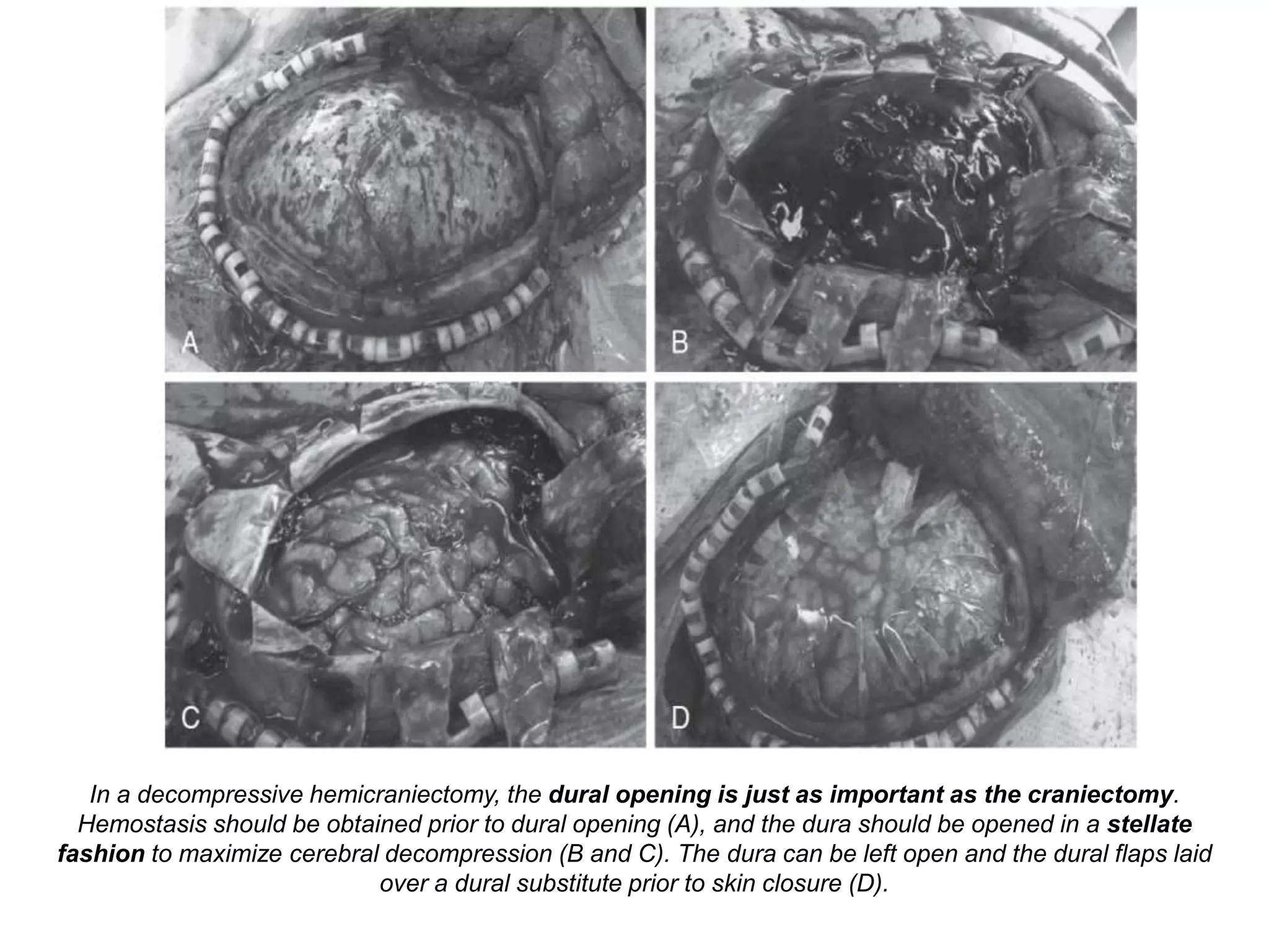 Decompressive Craniectomy.pptx