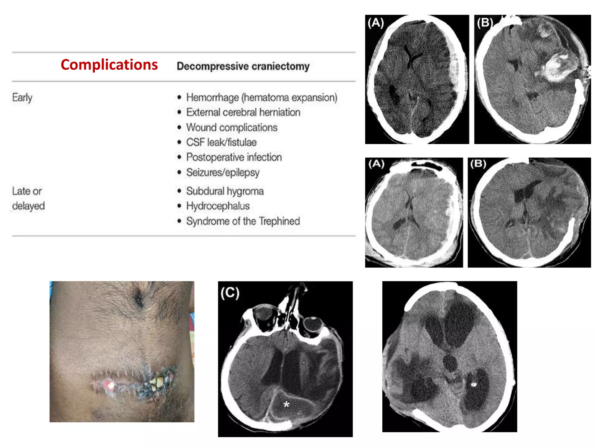 Decompressive Craniectomy.pptx