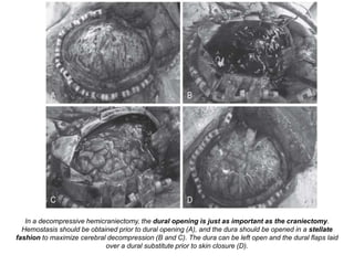 Decompressive Craniectomy.pptx