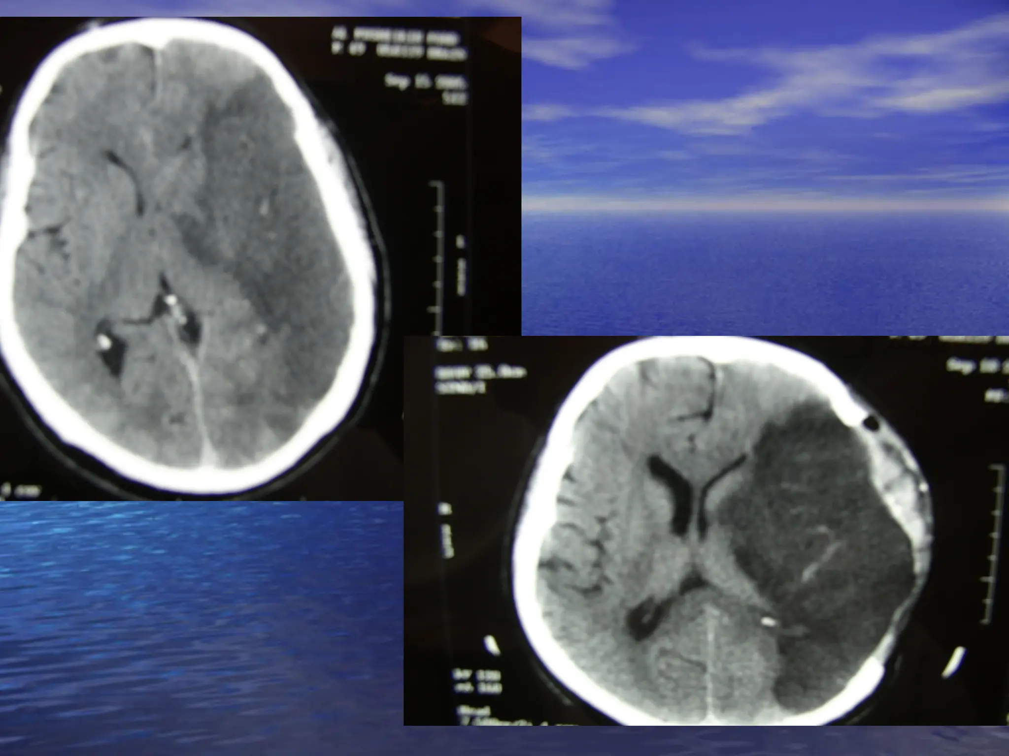 decompressive_craniectomy and it's managemnet | PDF