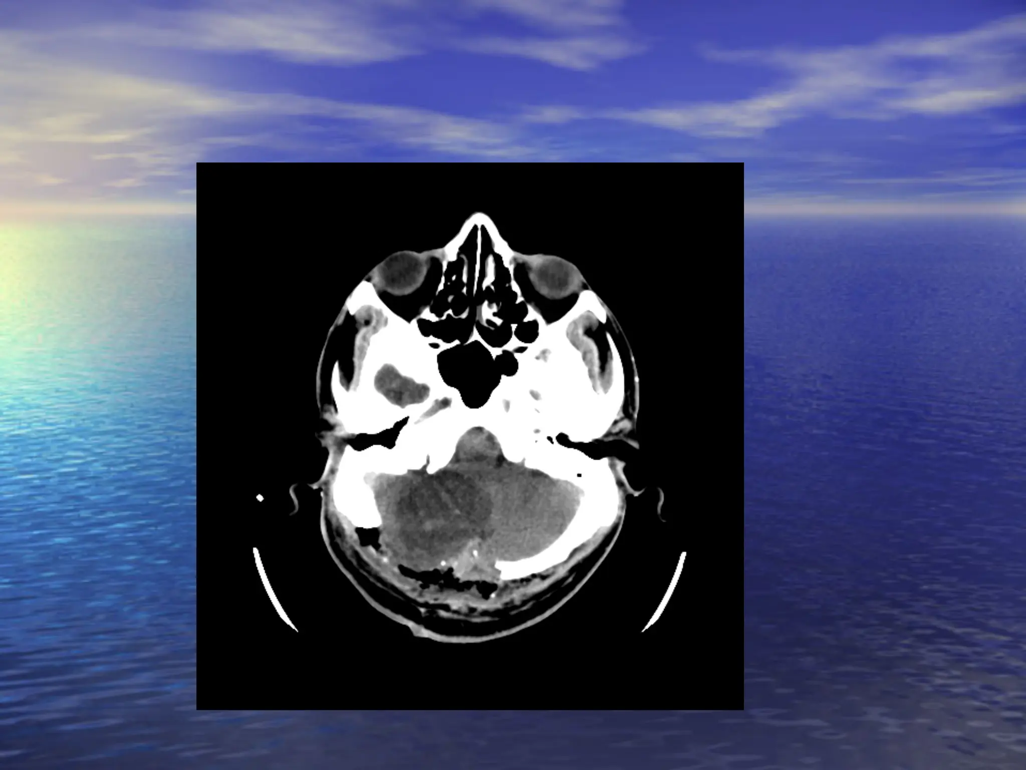 decompressive_craniectomy and it's managemnet | PDF