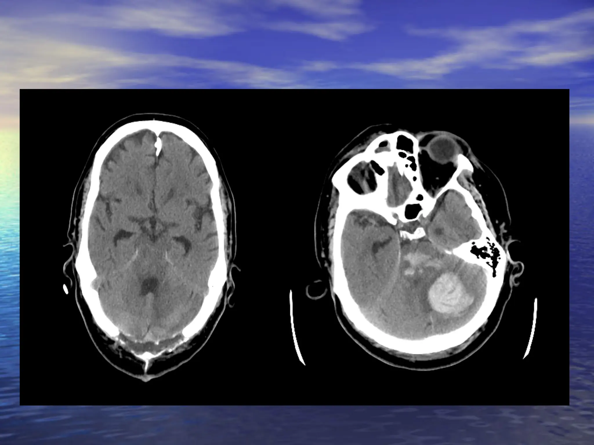decompressive_craniectomy and it's managemnet | PDF