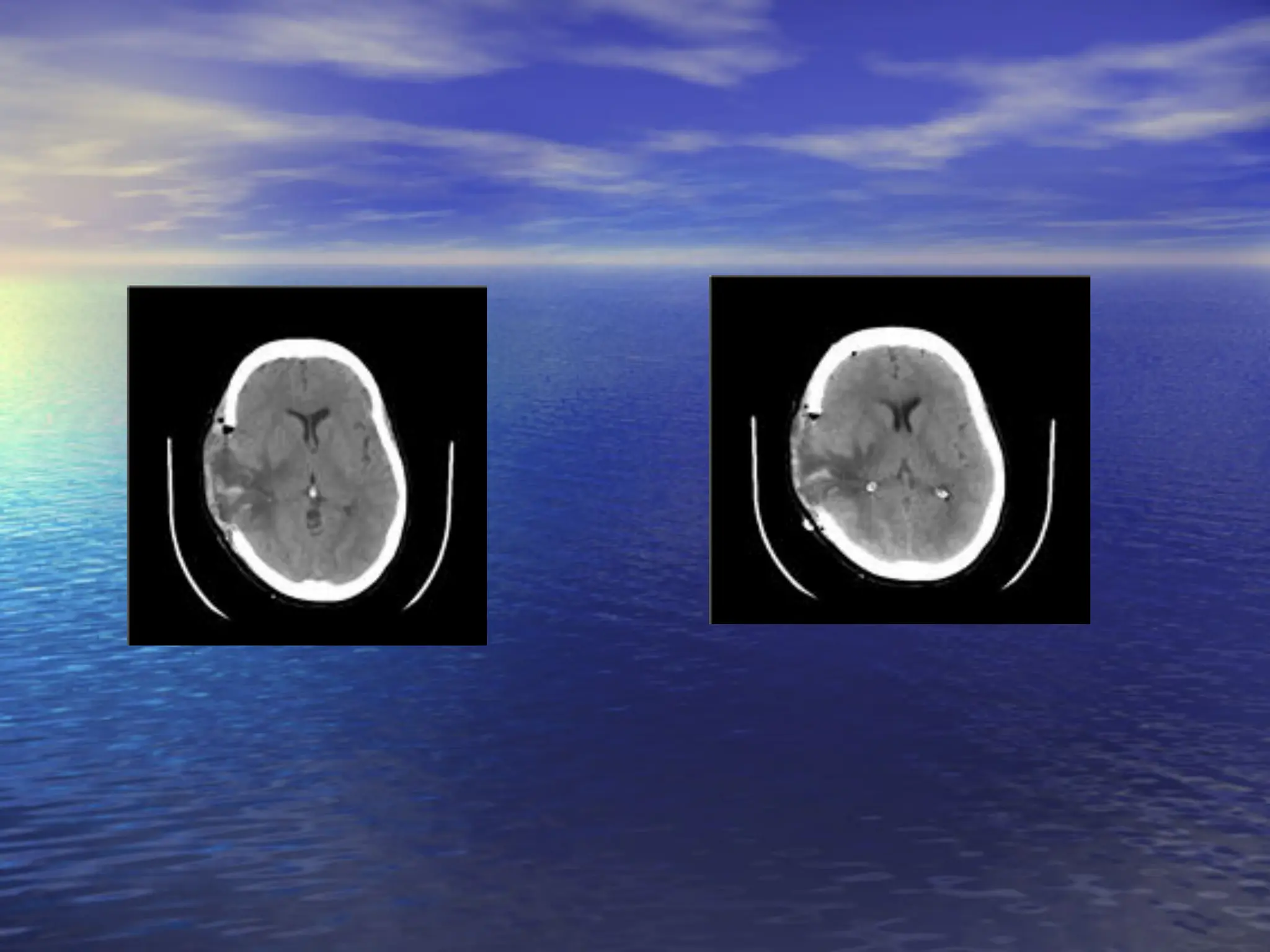 decompressive_craniectomy and it's managemnet | PDF