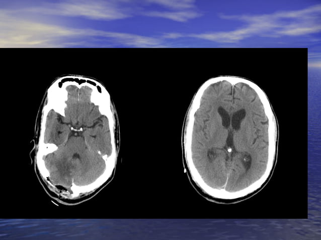 decompressive_craniectomy and it's managemnet | PPT