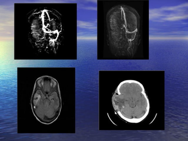 decompressive_craniectomy and it's managemnet | PPT