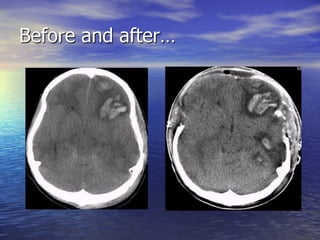 decompressive_craniectomy and it's managemnet | PDF