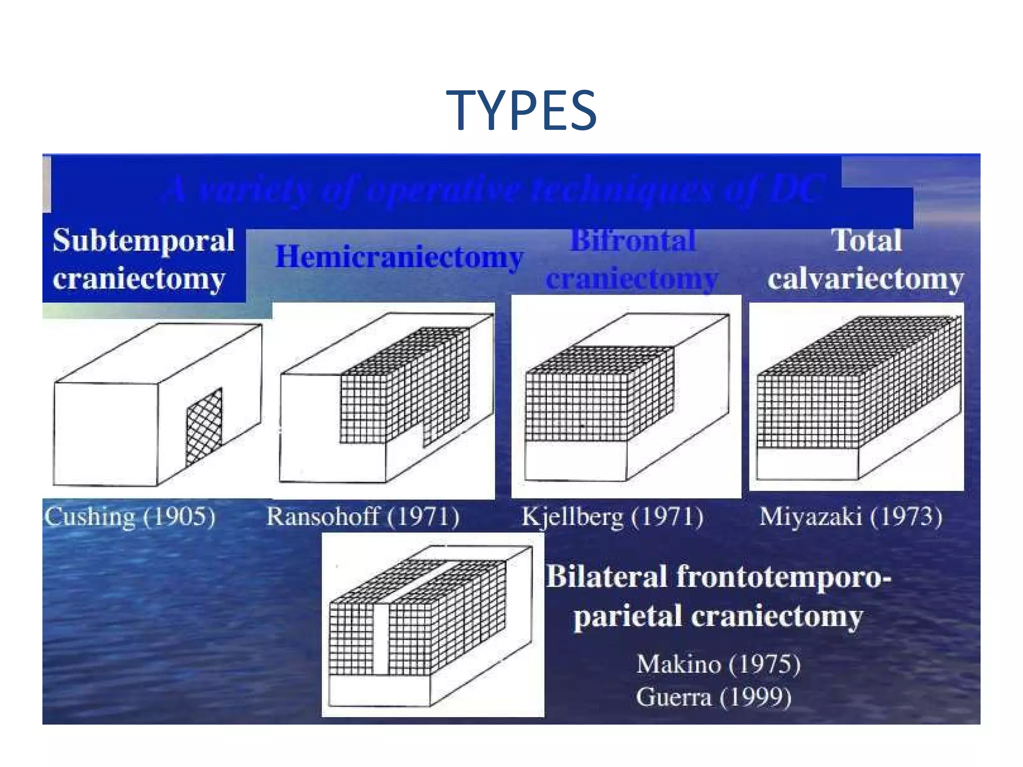 DECOMPRESSIVE CRANIECTOMY - DR SHAMEEJ | PPT