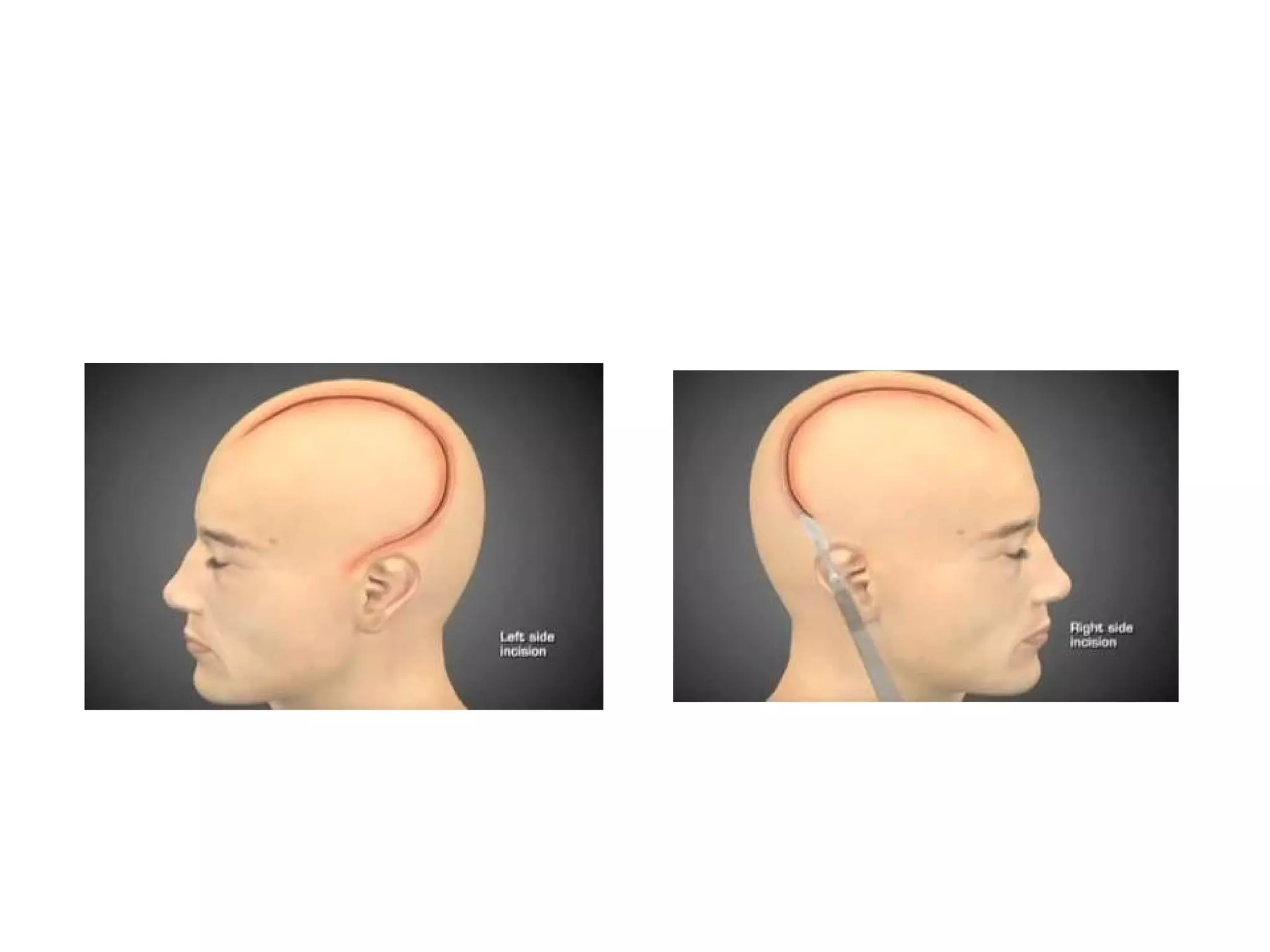 DECOMPRESSIVE CRANIECTOMY - DR SHAMEEJ | PPT