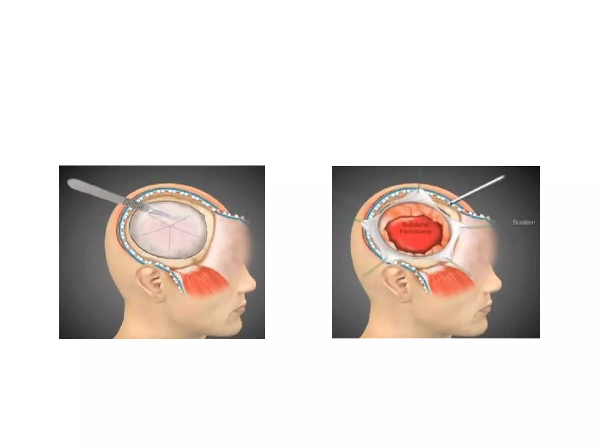 DECOMPRESSIVE CRANIECTOMY - DR SHAMEEJ | PPT