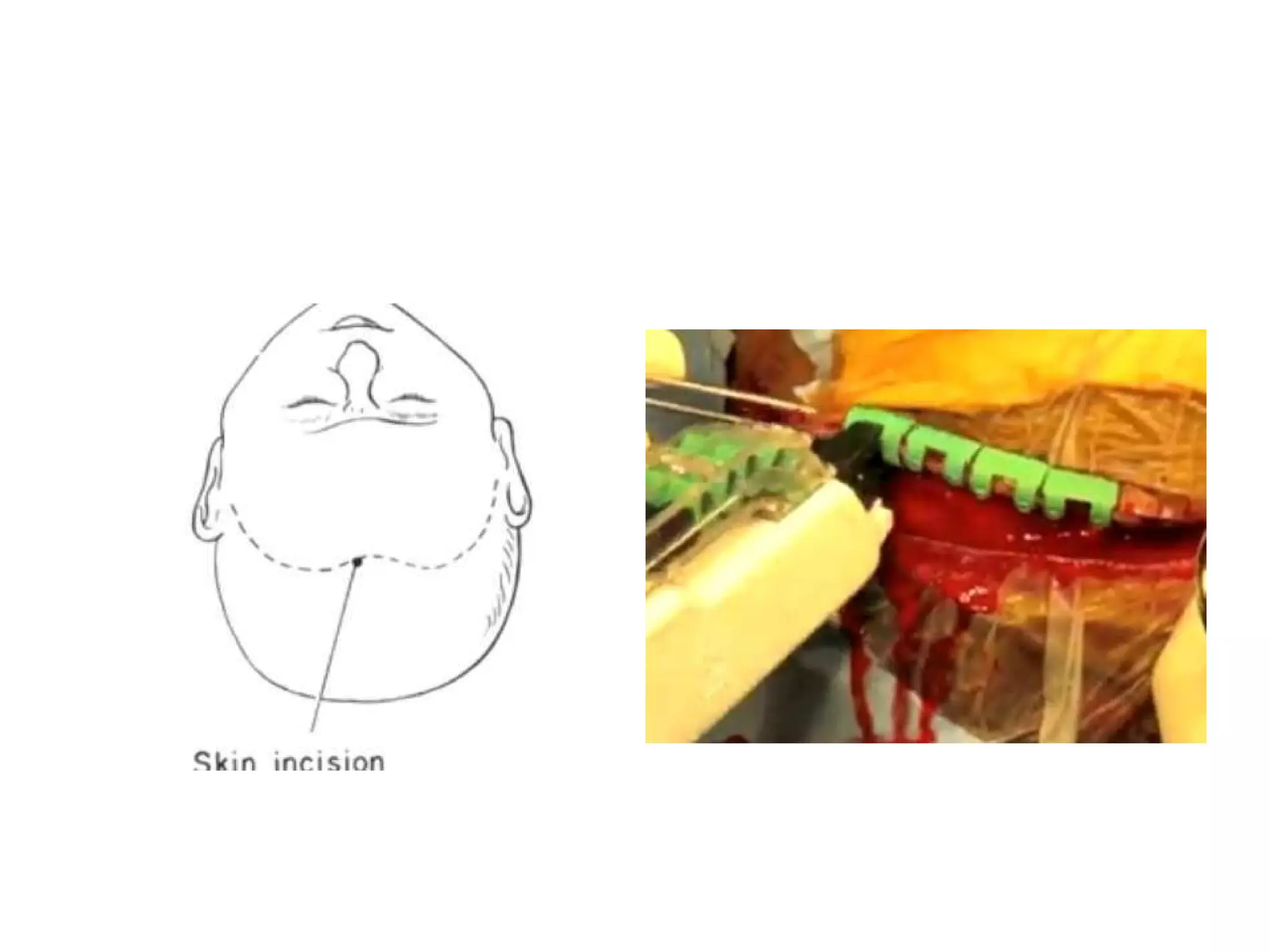 DECOMPRESSIVE CRANIECTOMY - DR SHAMEEJ | PPT