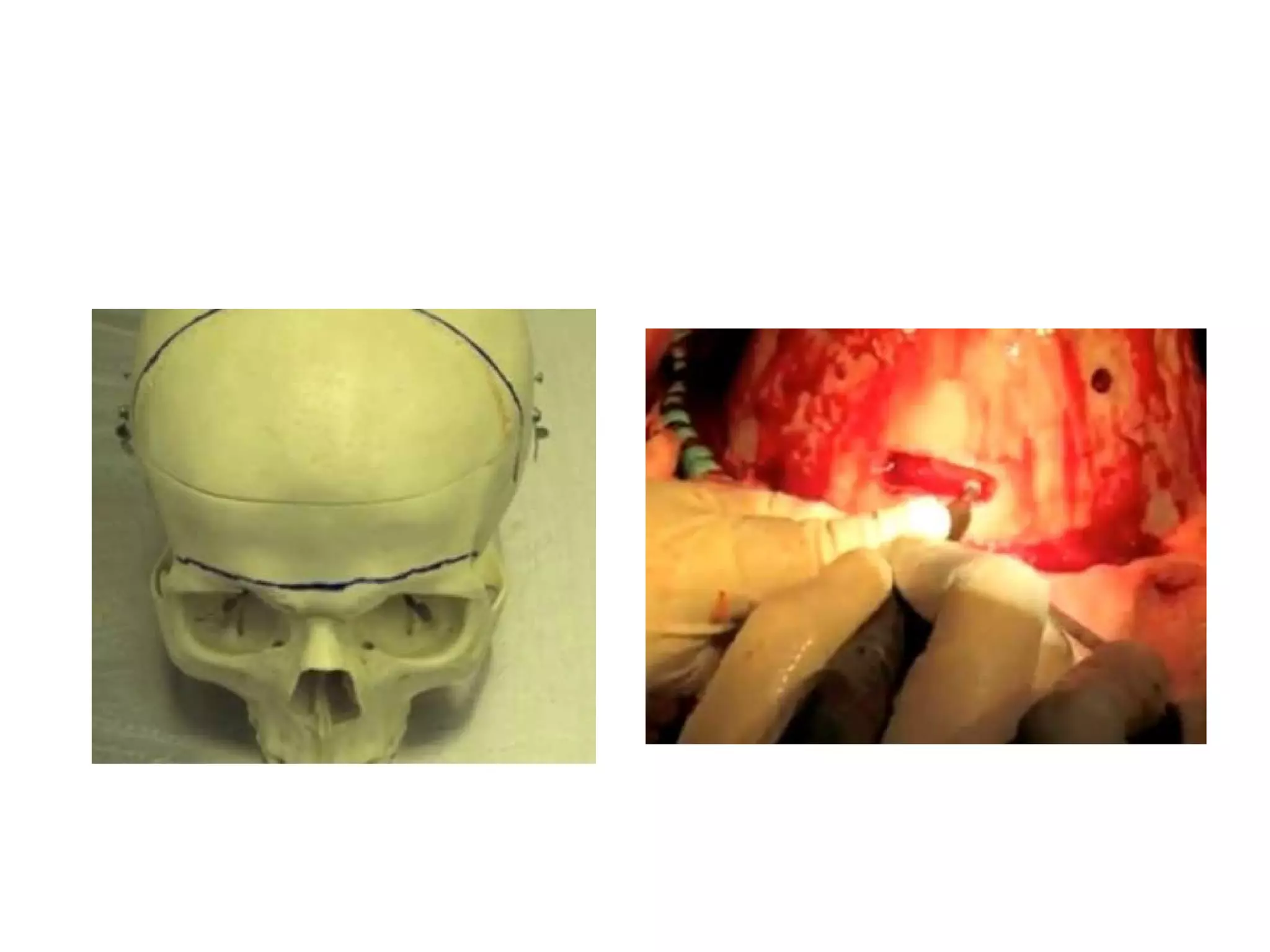 DECOMPRESSIVE CRANIECTOMY - DR SHAMEEJ | PPT