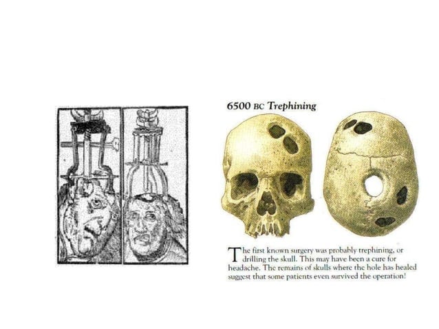 DECOMPRESSIVE CRANIECTOMY - DR SHAMEEJ | PPT