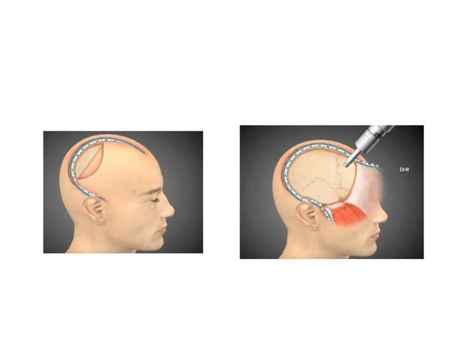 DECOMPRESSIVE CRANIECTOMY - DR SHAMEEJ | PPT