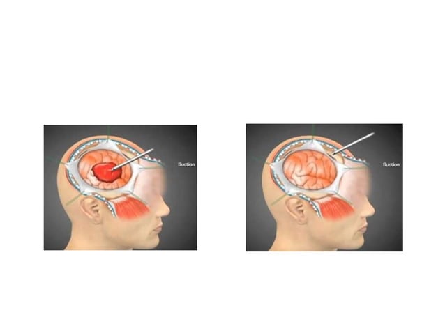 DECOMPRESSIVE CRANIECTOMY - DR SHAMEEJ | PPT
