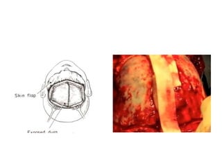 DECOMPRESSIVE CRANIECTOMY - DR SHAMEEJ | PPT