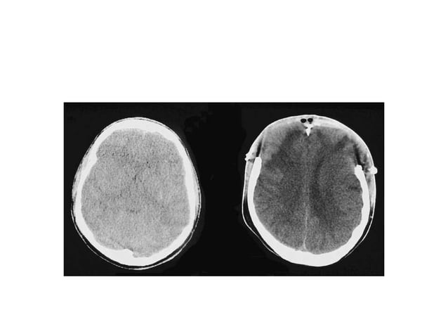 DECOMPRESSIVE CRANIECTOMY - DR SHAMEEJ | PPT