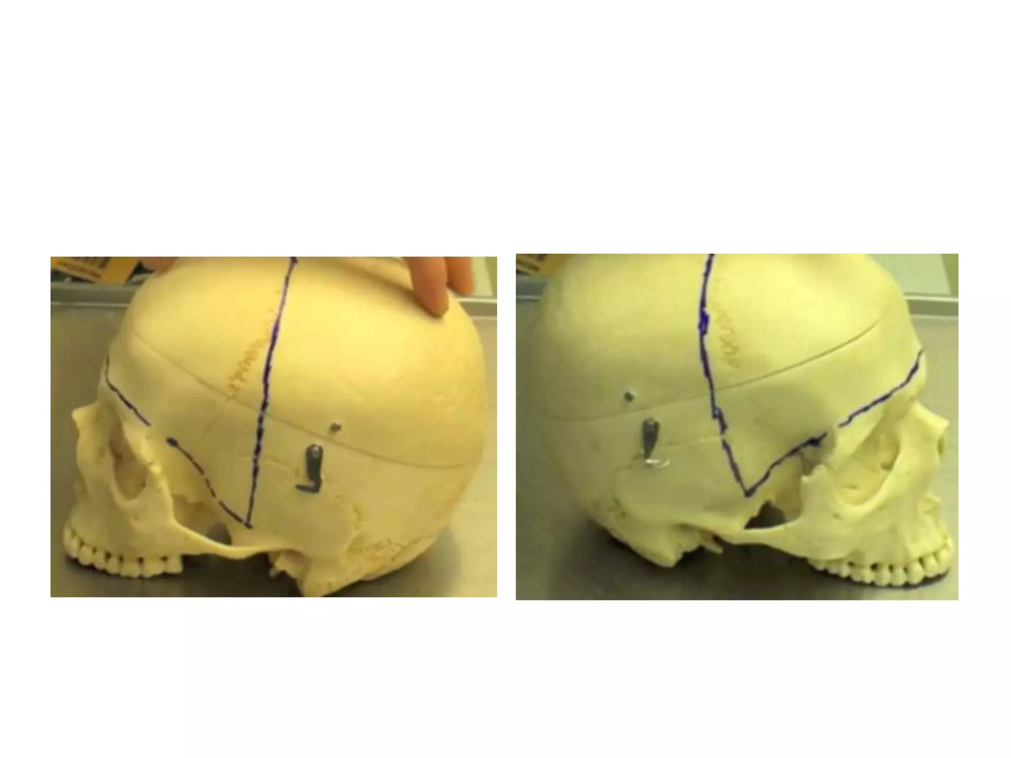 Decompressive craniectomy in Traumatic Brain Injury | PPSX