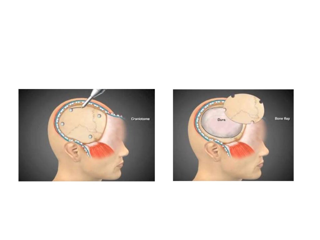 Decompressive craniectomy in Traumatic Brain Injury