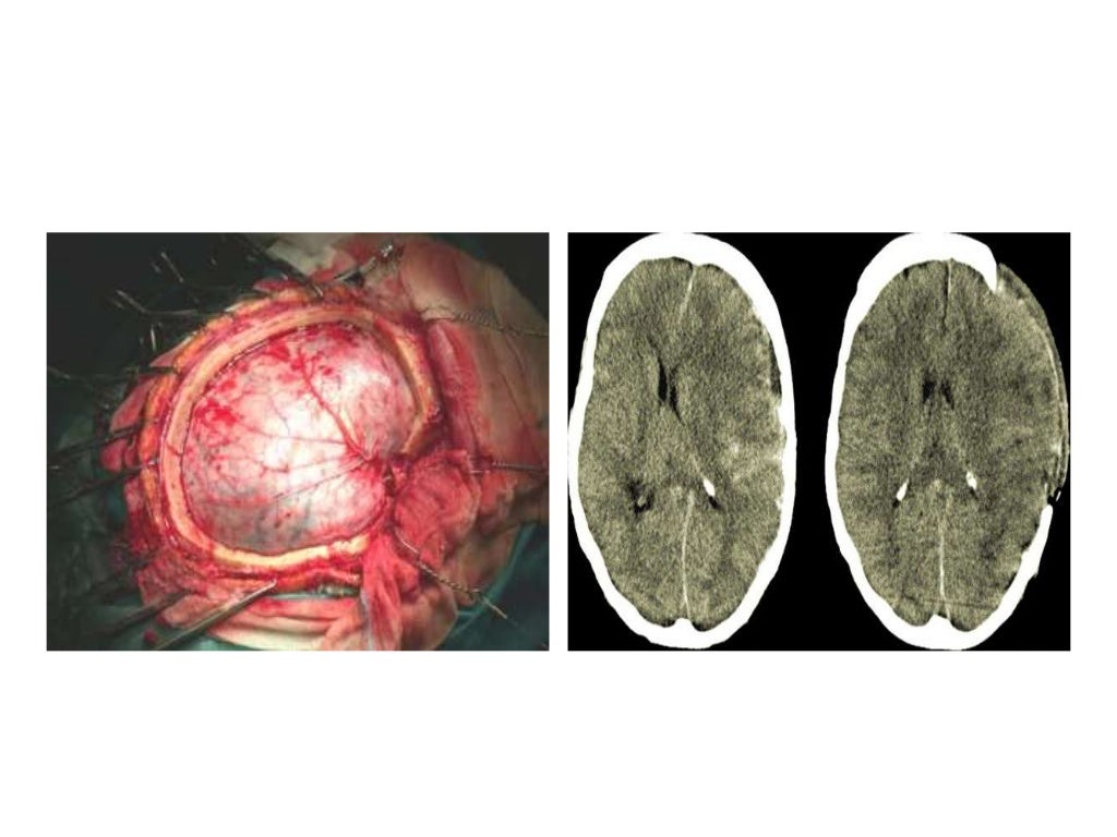 Decompressive craniectomy in Traumatic Brain Injury