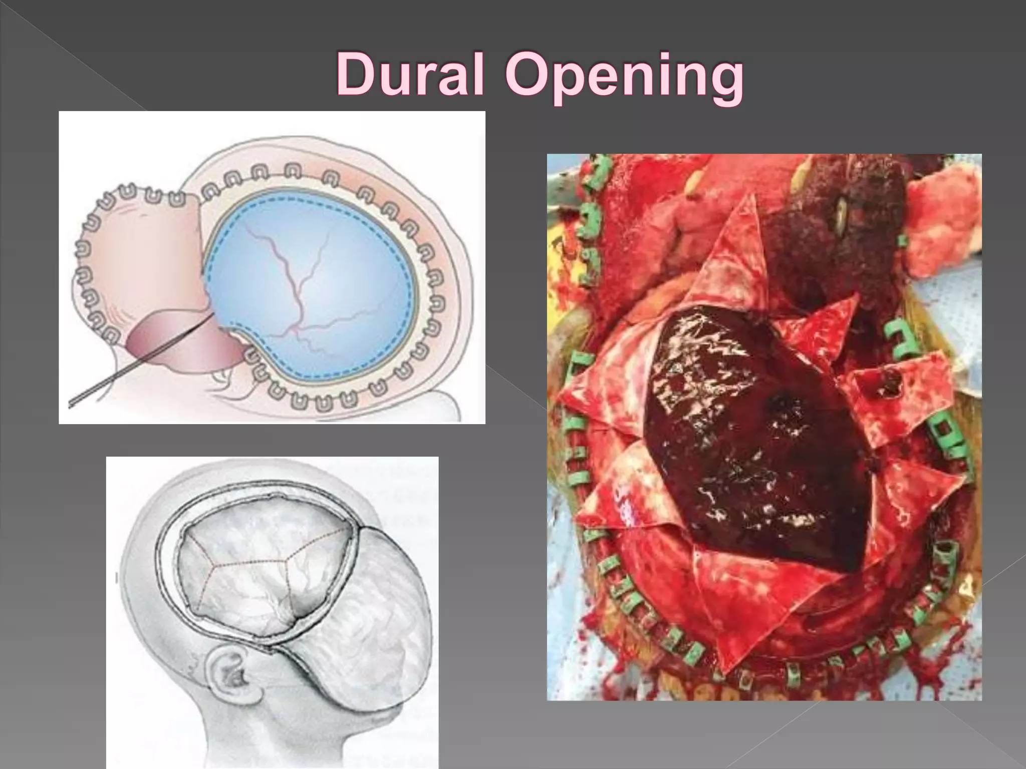 Decompressive craniectomy | PPTX