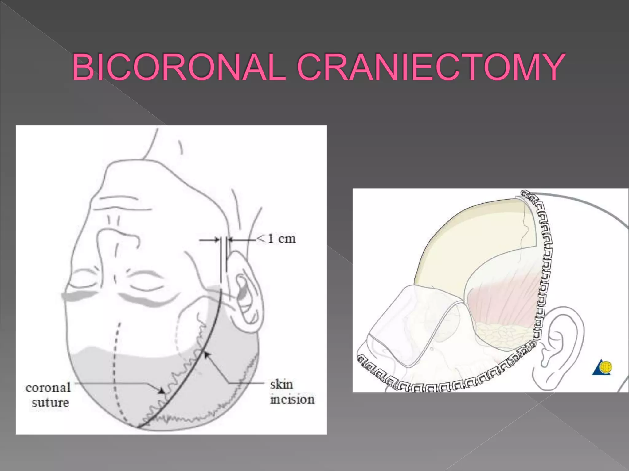 Decompressive craniectomy | PPTX