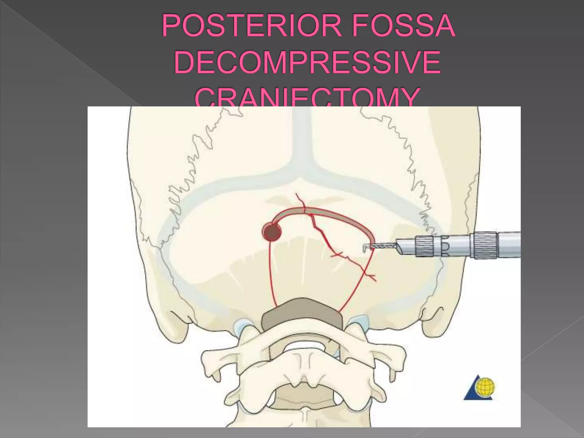 Decompressive craniectomy | PPTX