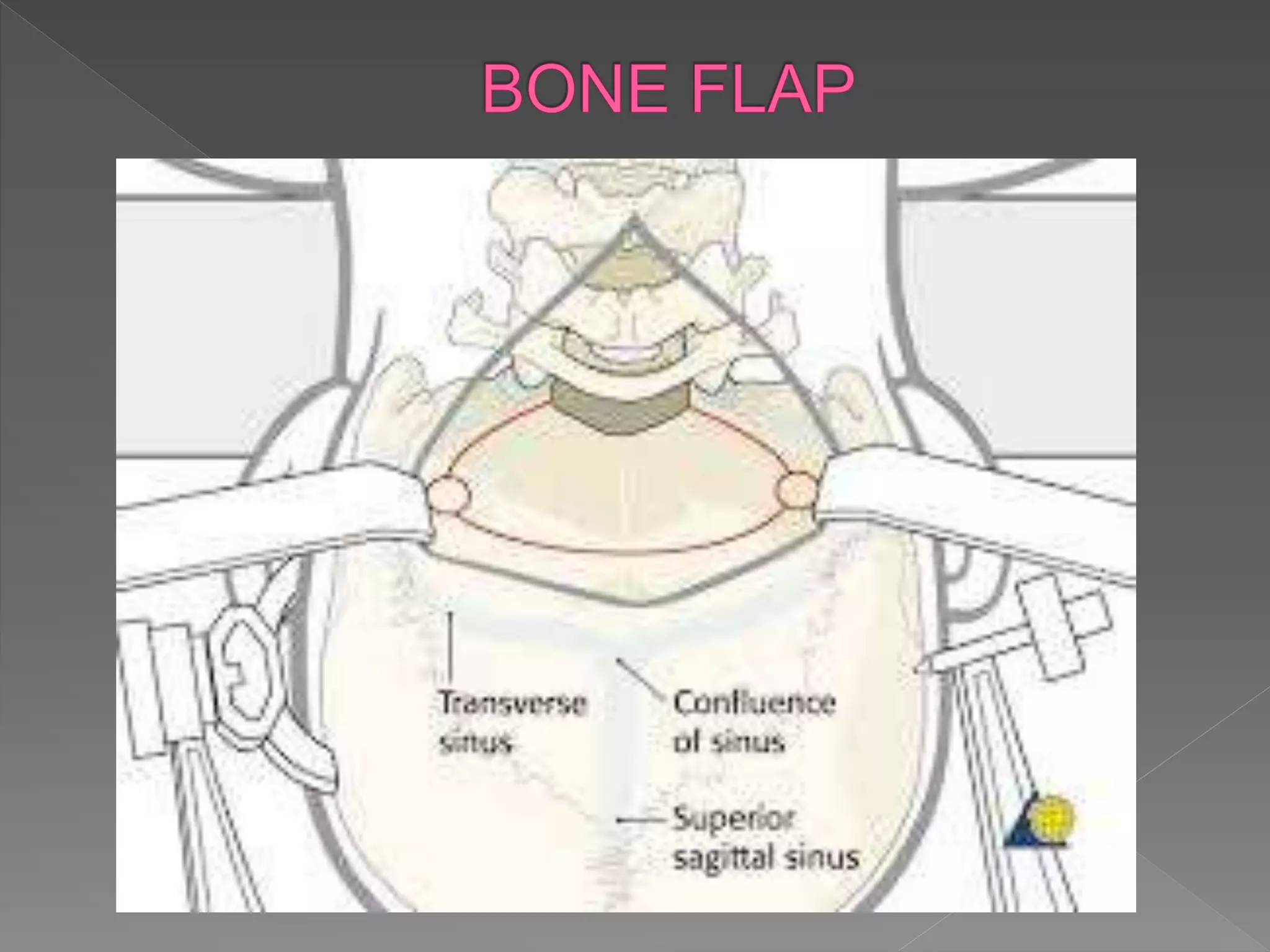 Decompressive craniectomy | PPTX