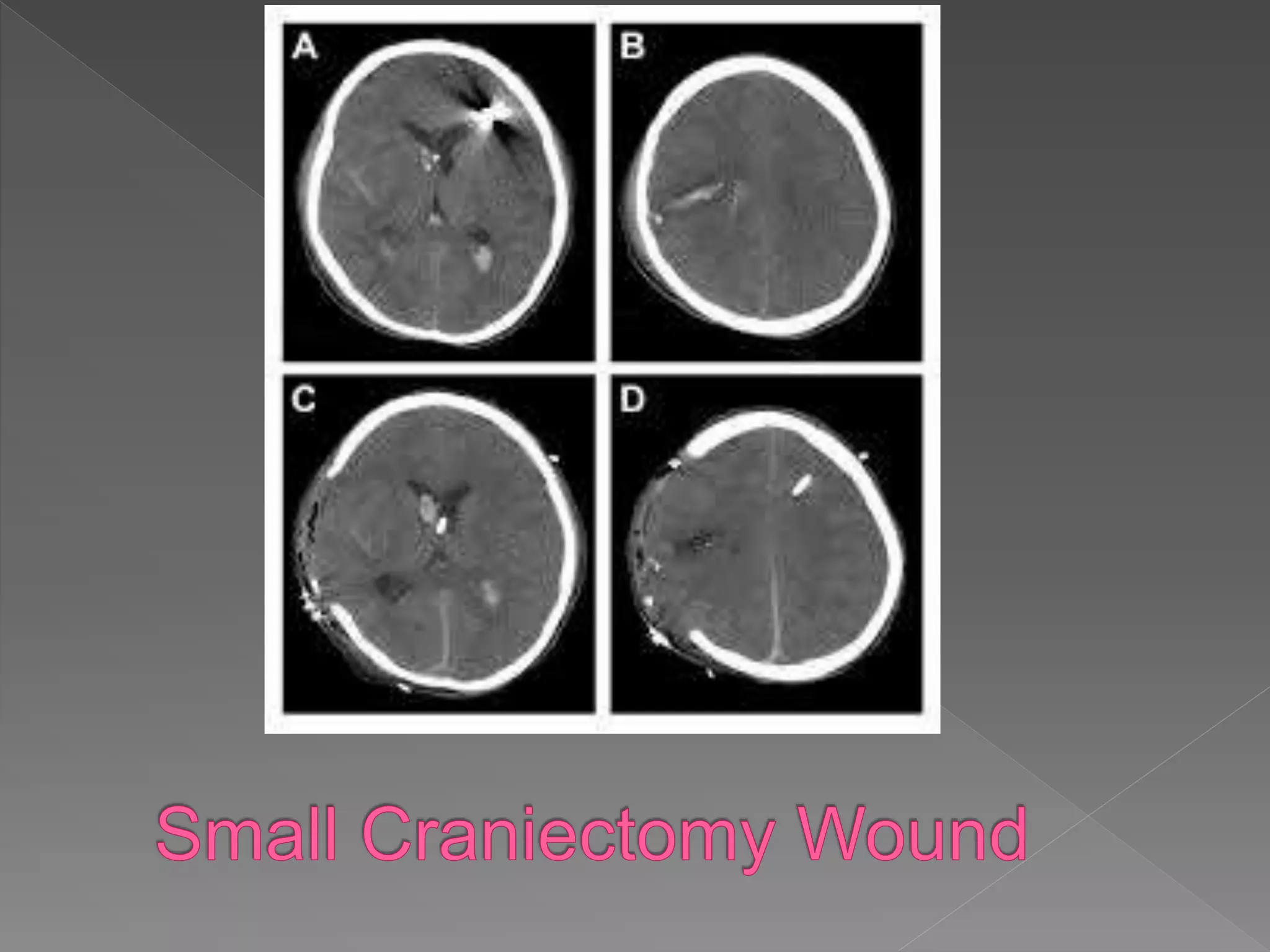 Decompressive craniectomy | PPTX