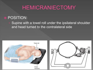 Decompressive craniectomy | PPTX