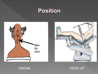 Decompressive craniectomy | PPTX