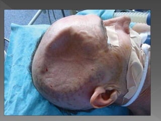Decompressive craniectomy | PPTX