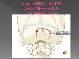 Posterior Fossa Craniotomy