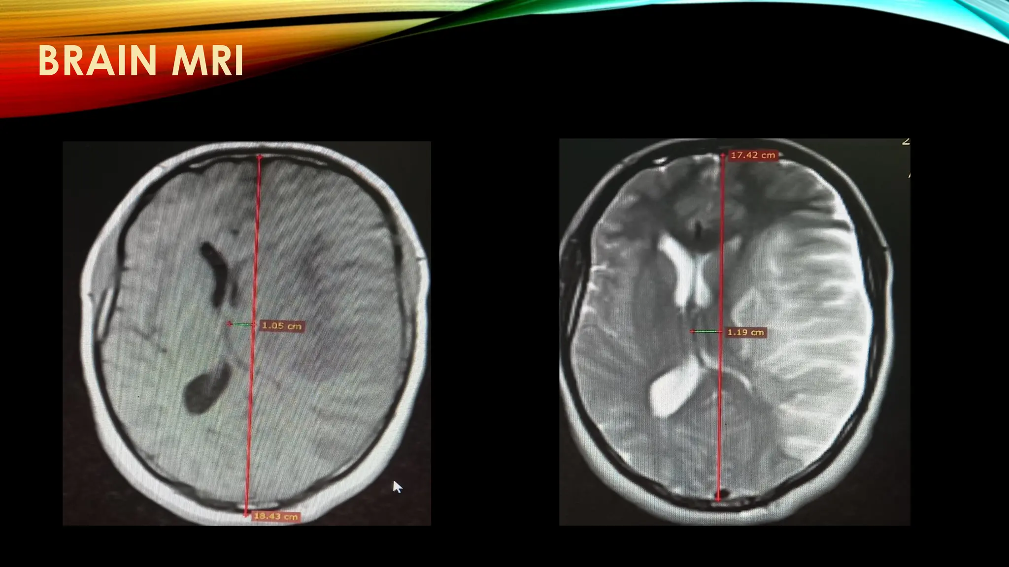 DECOMPRESSIVE CRANIECTOMY IN MALIGNANT ISCHEMIC INFARCTION OF THE ...