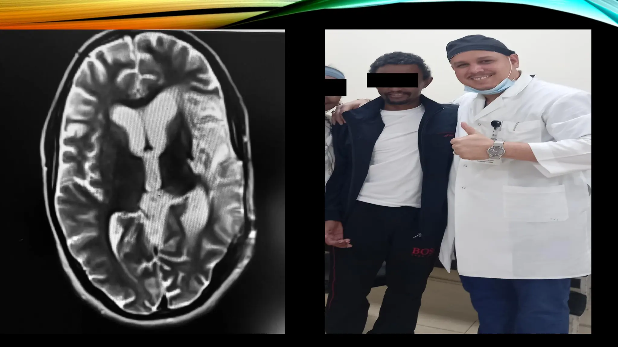 DECOMPRESSIVE CRANIECTOMY IN MALIGNANT ISCHEMIC INFARCTION OF THE ...