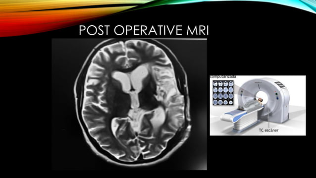 DECOMPRESSIVE CRANIECTOMY IN MALIGNANT ISCHEMIC INFARCTION OF THE ...