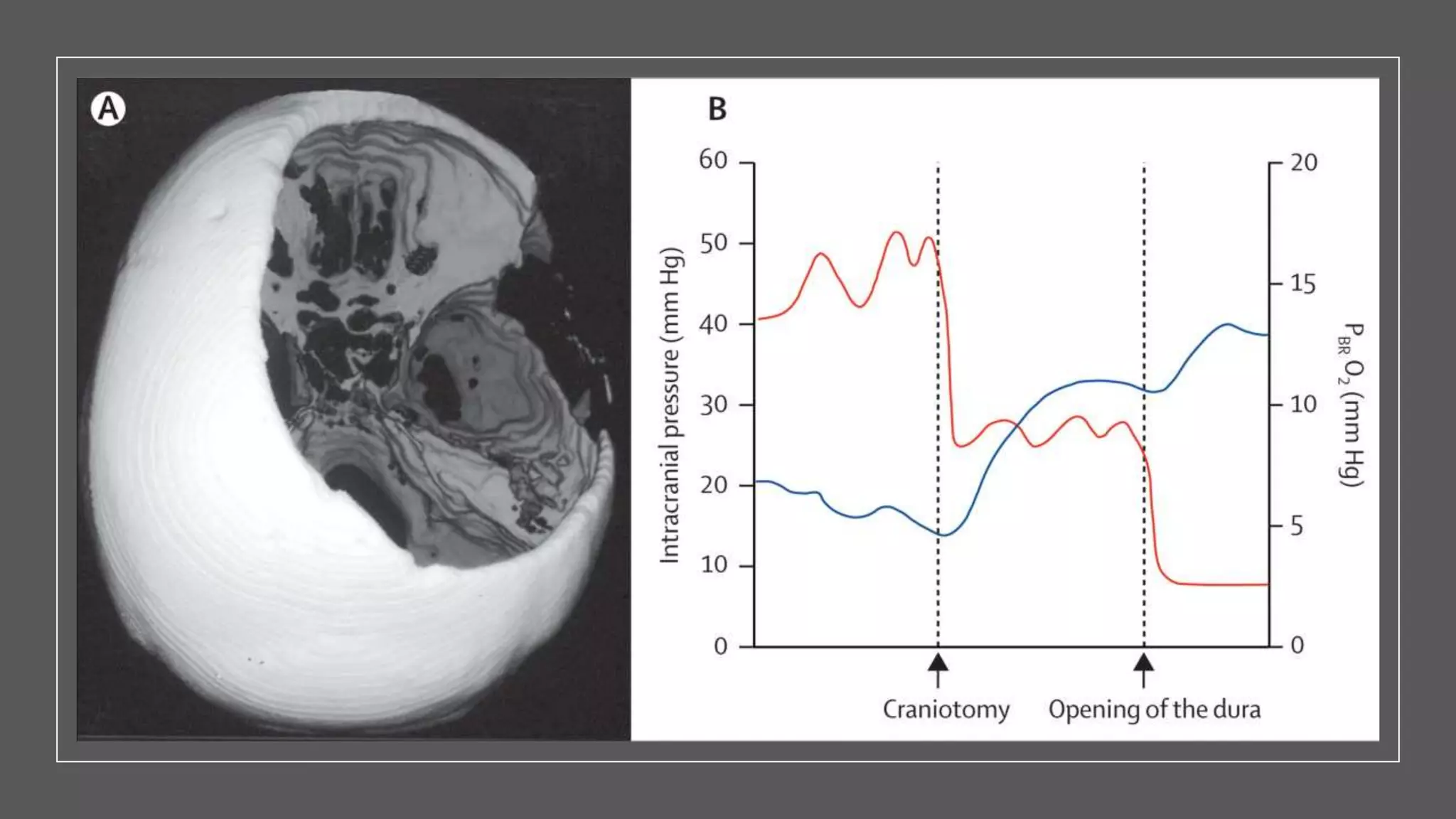 Decompressive hemicraniectomy for Large Hemispheric infarction | PPTX