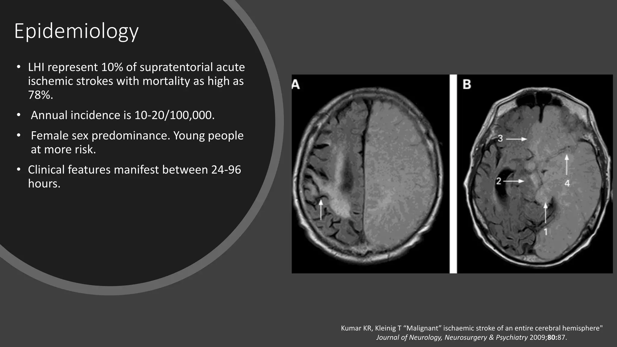 Decompressive hemicraniectomy for Large Hemispheric infarction | PPTX