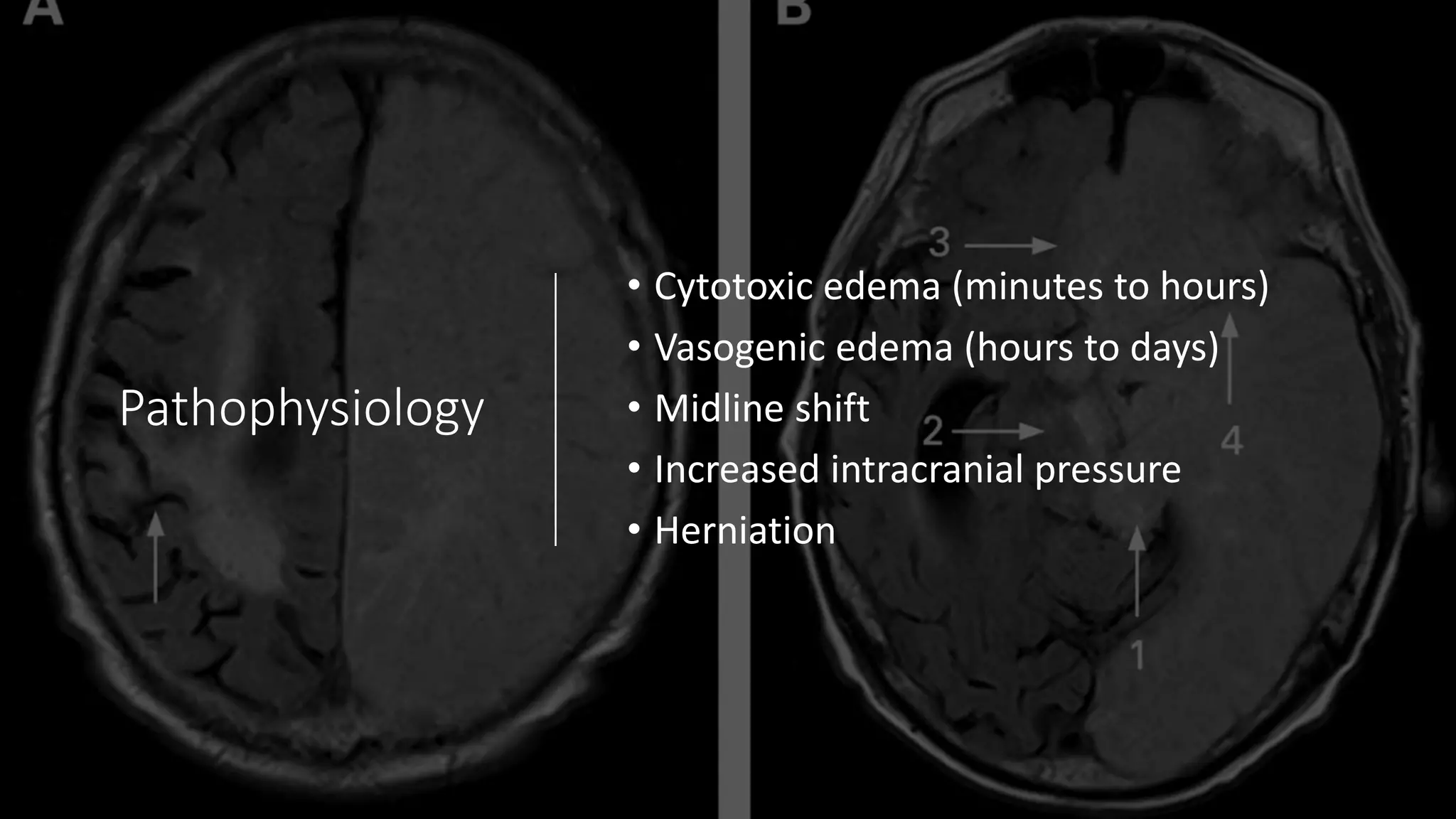 Decompressive hemicraniectomy for Large Hemispheric infarction | PPTX
