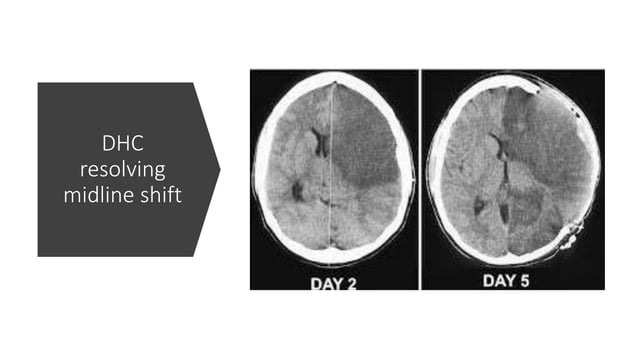 Decompressive hemicraniectomy for Large Hemispheric infarction | PPT