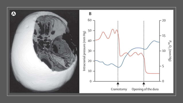 Decompressive hemicraniectomy for Large Hemispheric infarction | PPT