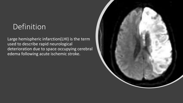 Decompressive hemicraniectomy for Large Hemispheric infarction | PPT