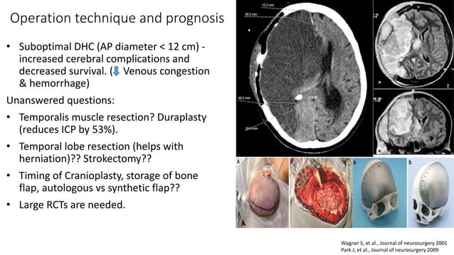 Decompressive hemicraniectomy for Large Hemispheric infarction | PPT