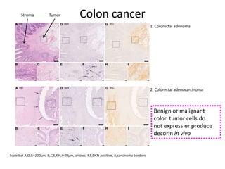 Decorin in human epithelial cancers | PPT